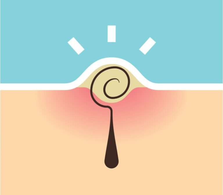 Wat is een ingegroeide haar? - Dutch Hairshop